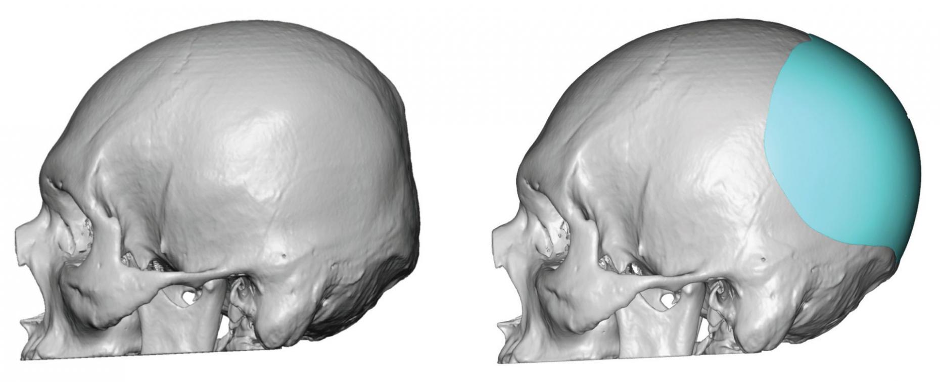 Occipital Surgery for Flat Spots on Head | Dr. Barry L. Eppley