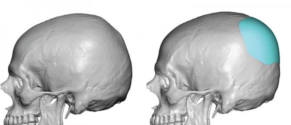 Occipital Surgery for Flat Spots on Head | Dr. Barry L. Eppley