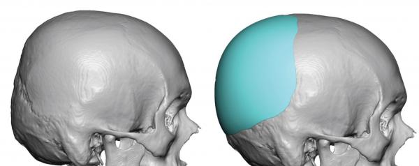 Occipital Surgery for Flat Spots on Head | Dr. Barry L. Eppley