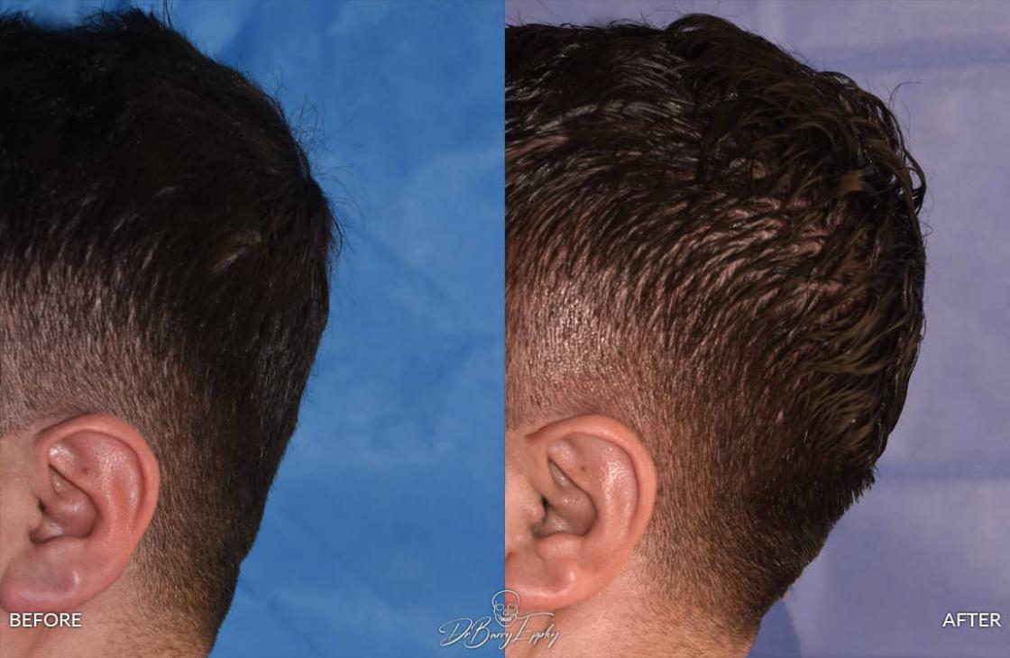 Occipital Surgery for Flat Spots on Head | Dr. Barry L. Eppley