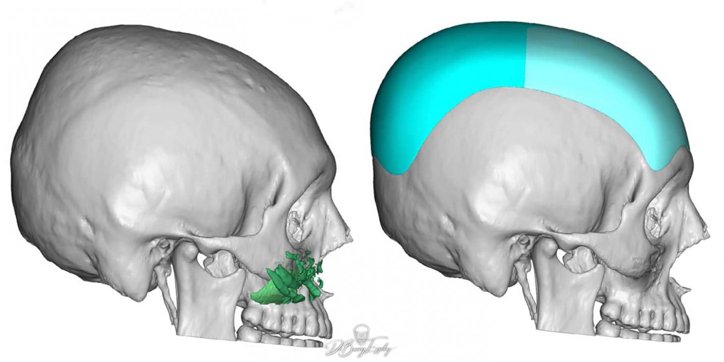 Skull Augmentation & Reduction | Dr. Barry L. Eppley