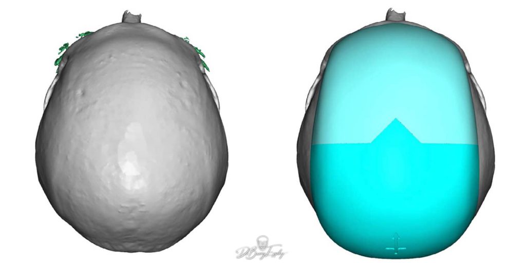 Skull Augmentation & Reduction | Dr. Barry L. Eppley