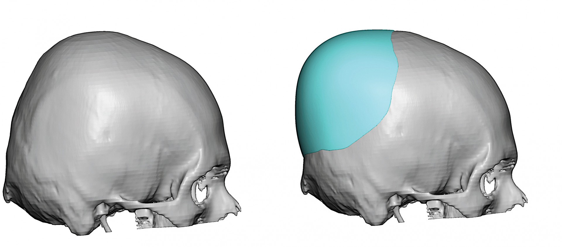 Bump On Back Of Skull