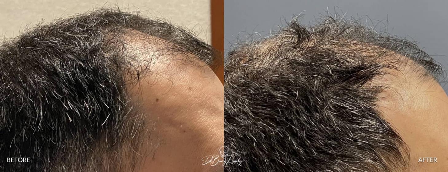 Sagittal Skull Surgery for Peaked Head Shape | Dr. Eppley