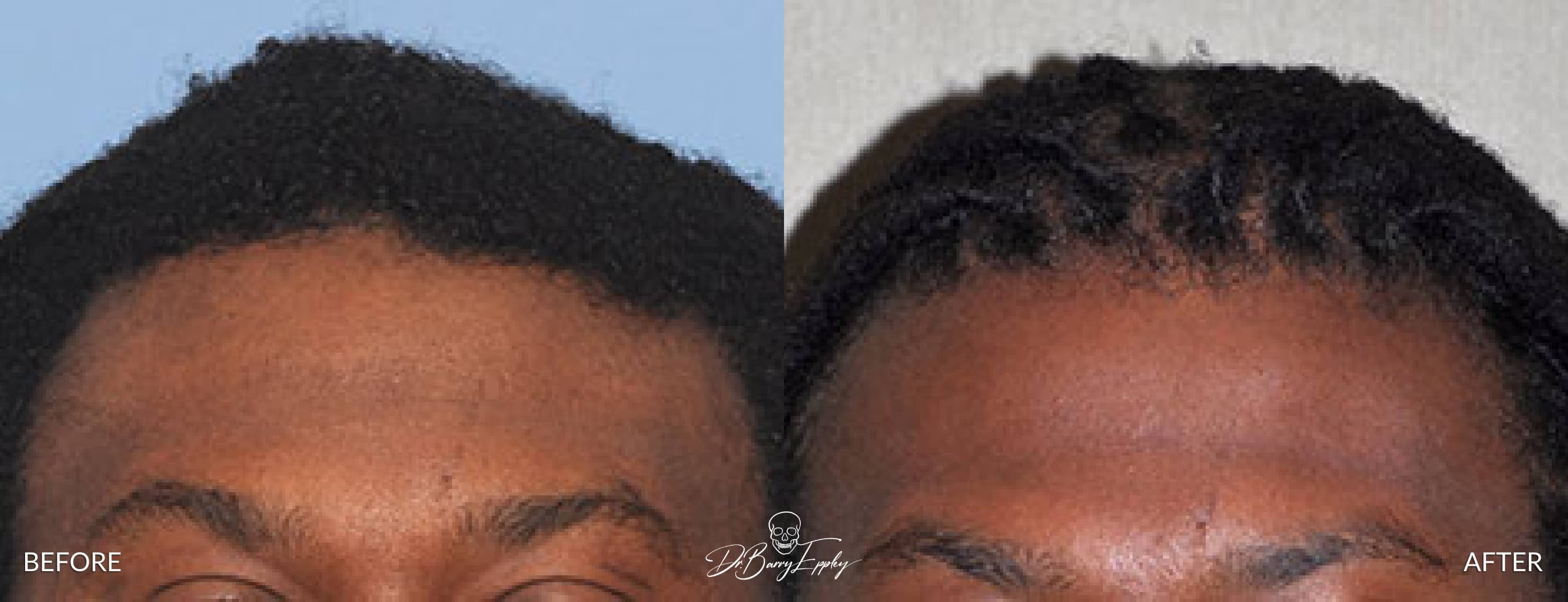 Sagittal Skull Surgery for Peaked Head Shape | Dr. Eppley