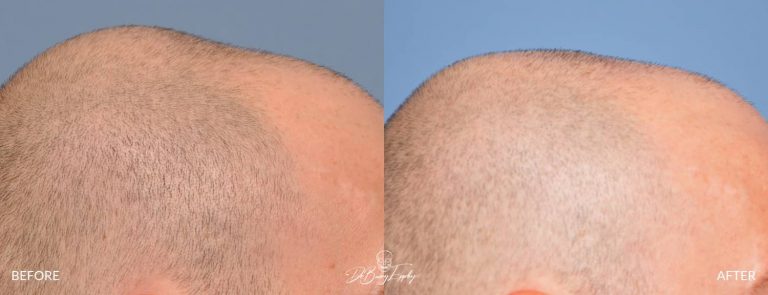 Sagittal Skull Surgery for Peaked Head Shape | Dr. Eppley
