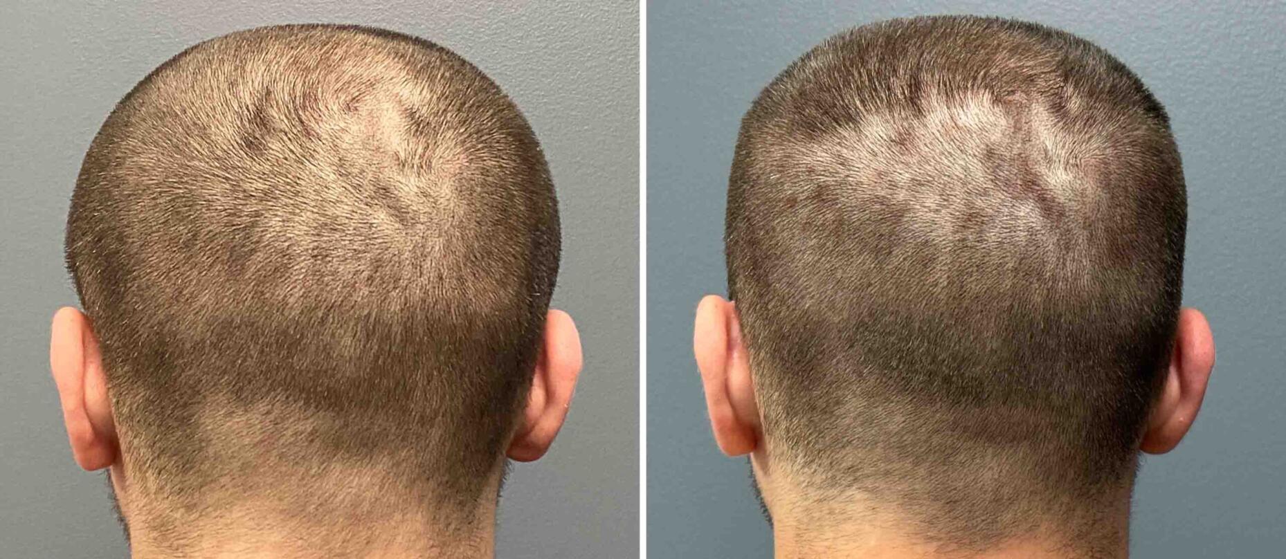 Temporal Skull Surgery to Fill Hollows | Dr. Barry L. Eppley